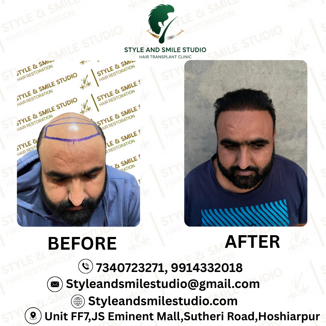 Successful Hair Transplant Results | Natural & Permanent